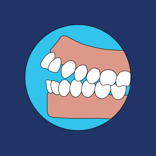 Clear Aligners for Open Bite | Aligner Experts | Chicago